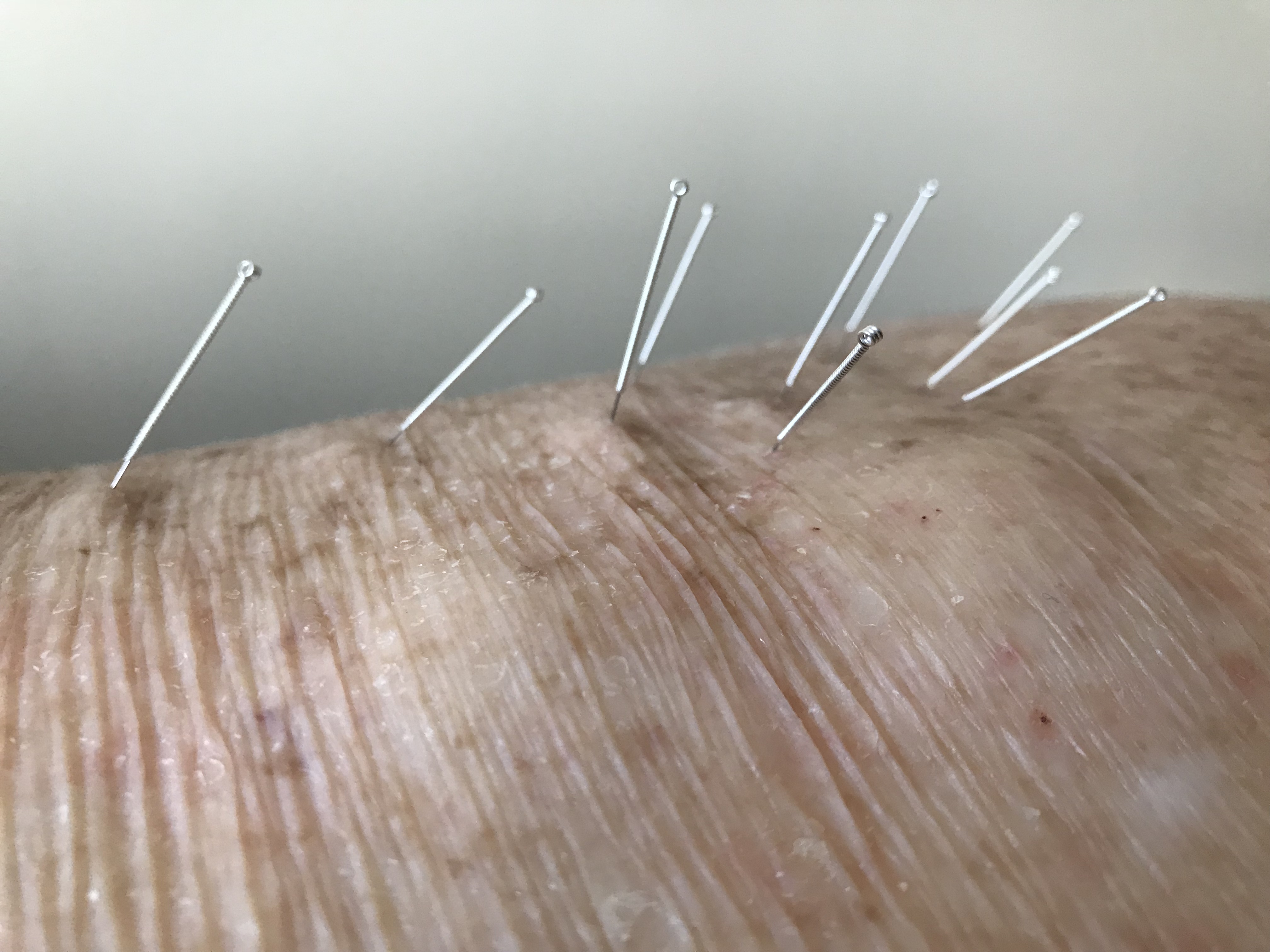 Trigger Point Therapy | Jonathan Hearsey